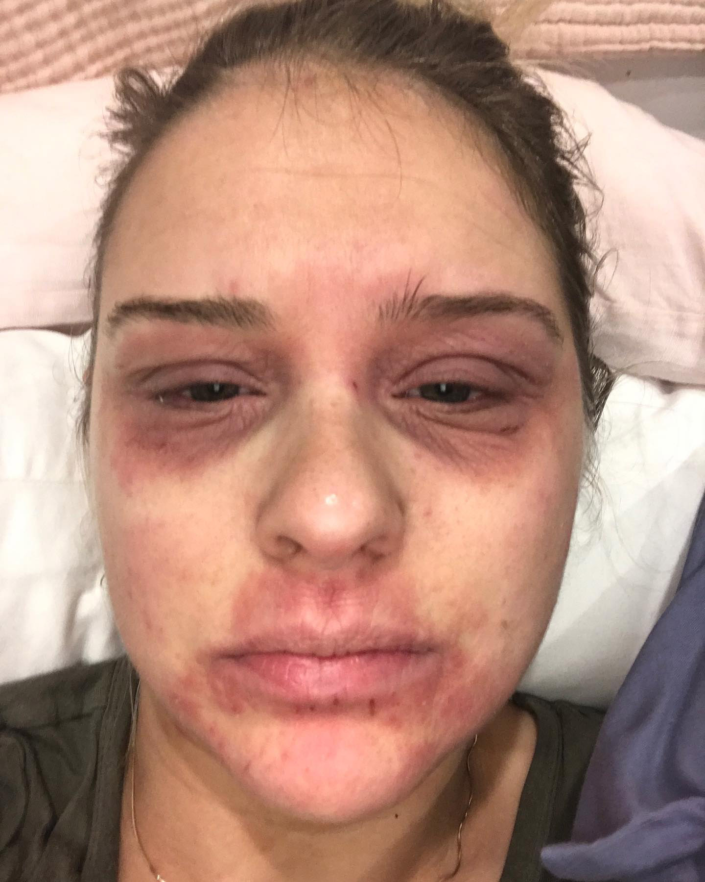 ‘I thought I was allergic to the gym – but it was eczema cream ...