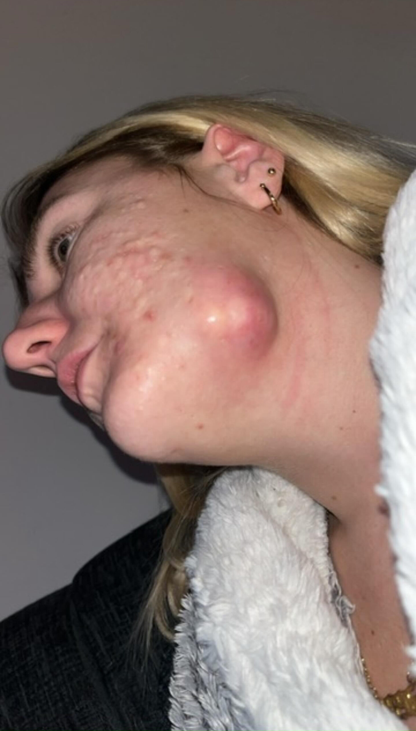 ‘Acne medication gave me huge cysts – I wear a scarf to cover my face ...